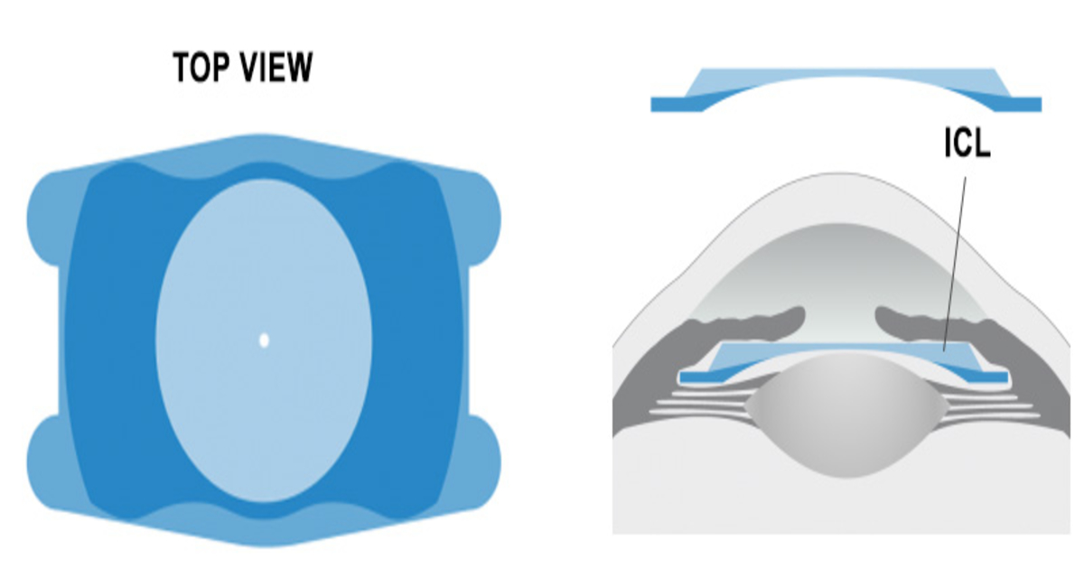 Implantable Collamer Lens - Jehan Eye Clinic